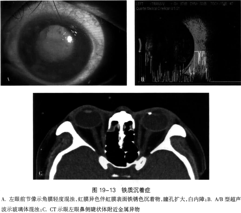疾病搜索 / 眼科 / 眼内异物_世界医疗网